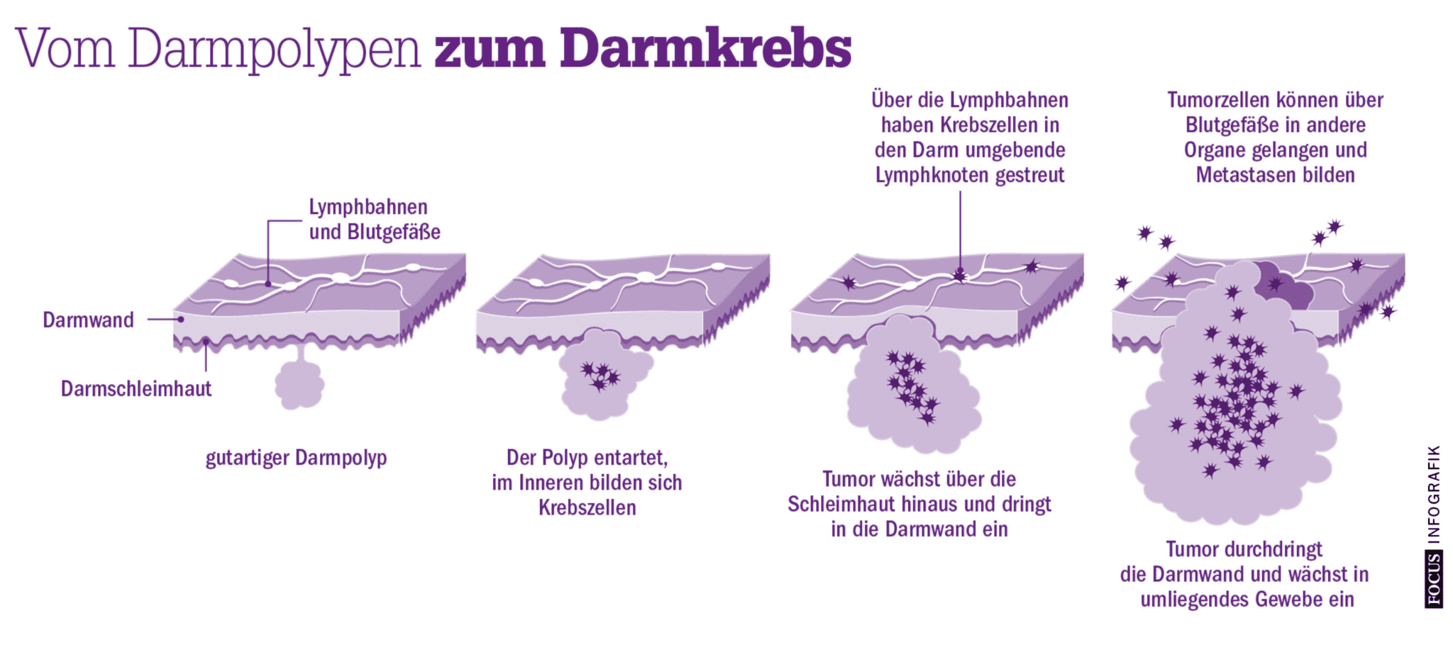 Darmkrebs, Vorsorge Und Risiko — 12 Symptome Die Du Kennen Solltest. ⋆ ...